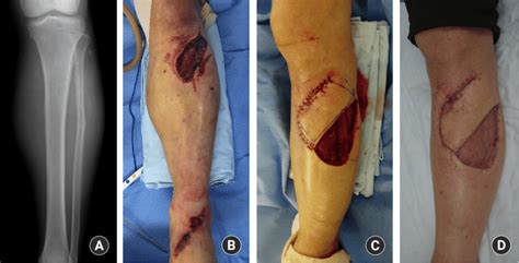 A B A 53 Year Old Male Patient With Open Tibiofibular Fracture Download Scientific Diagram