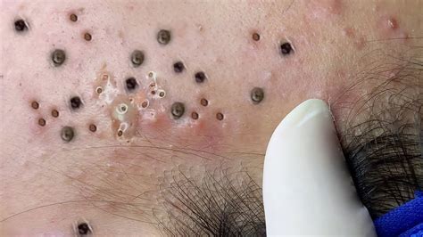 𝐄𝐱𝐭𝐫𝐞𝐦𝐞 𝐁𝐥𝐚𝐜𝐤𝐡𝐞𝐚𝐝 𝐑𝐞𝐦𝐨𝐯𝐚𝐥 𝐚𝐭 𝐓𝐇𝐒 𝟔𝟕𝟏𝟑 Youtube