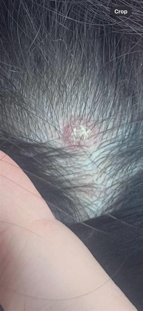 Scalp Bump Rdermatologyquestions