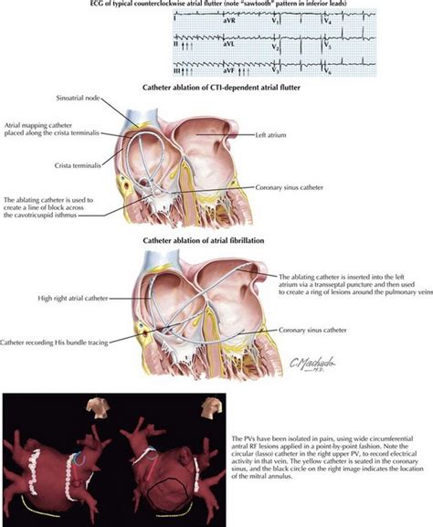 Catheter Ablation Of Cardiac Arrhythmias Thoracic Key