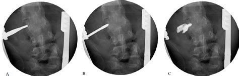 Figure 1 From Novel Screw Placement Method For Extremely Small Lumbar