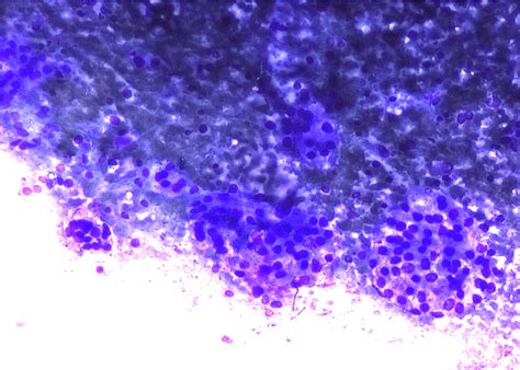 Basedows Disease Abundant Hematic Background And Sheets Of Follicular