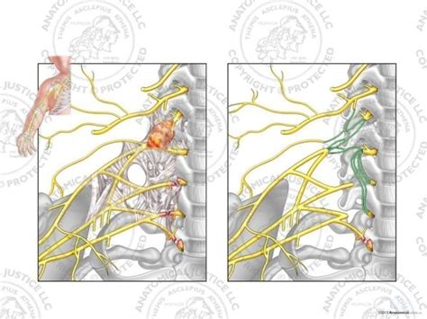 Right Brachial Plexus Neuroma And Nerve Grafts No Text