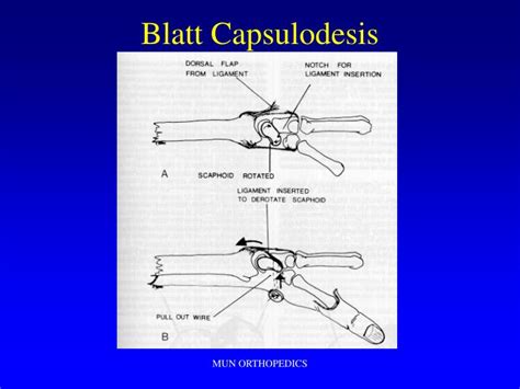 What Is Capsulodesis At Skye Kinsella Blog