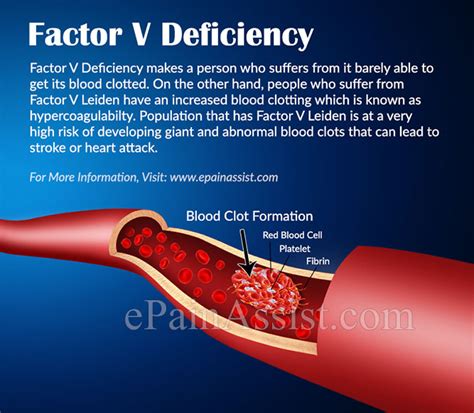 Factor V Deficiency Or Owrens Disease Causessymptomstreatment