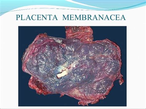 Placenta Membranacea Placenta At Term Midwives Revision