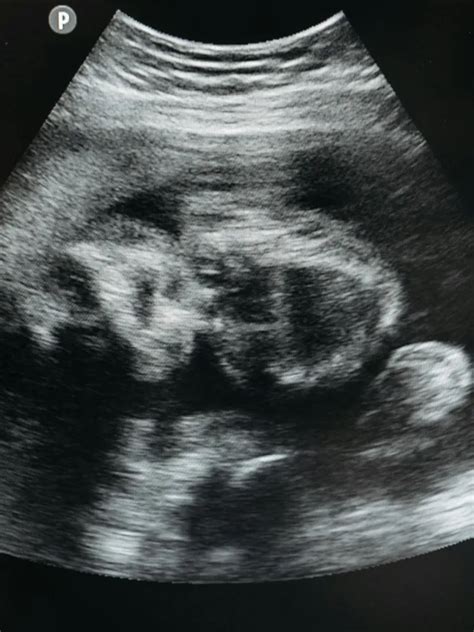 Ultrasound Scans In Limerick With Insight Ultrasound