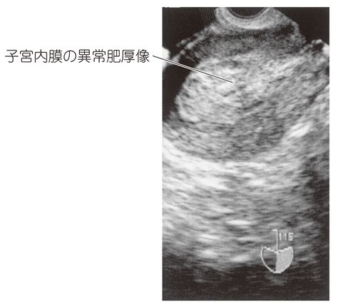 100C22 子宮体癌 国試 M3E Medical