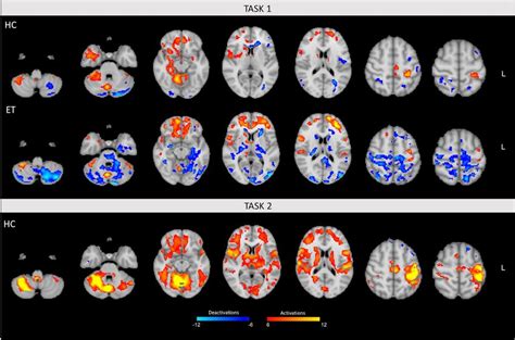 Activation And Deactivation Maps Fixed Effects Group Analysis Results Download Scientific