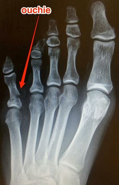 Broken Toe X Ray