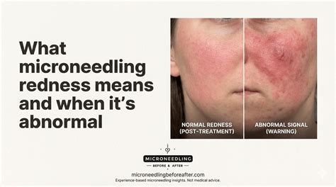 What Microneedling Redness Means And When Its Abnormal