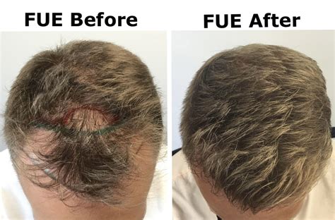 Hair Raising Decisions FUT Vs FUE Hair Transplants Examined