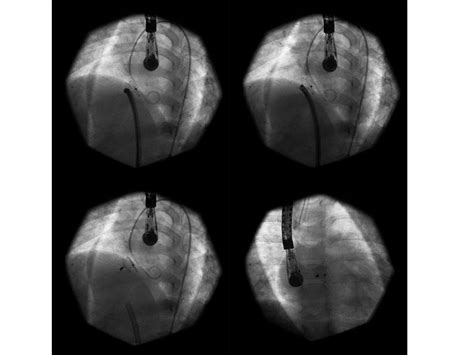 Vsd Device Closure
