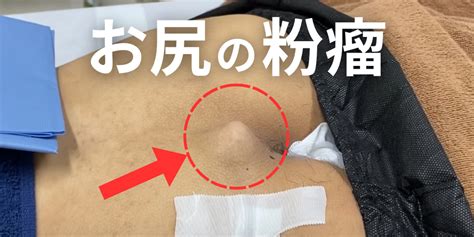 おしりの粉瘤は自然に治らない。痛みや腫れがある人は早めに専門医へ 北海道皮膚のできものと粉瘤クリニック古林形成外科 札幌院｜中央区大通にて皮膚悩みを土日祝も対応