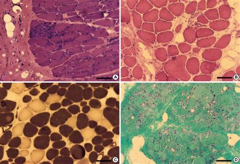 Muscle Biopsy Findings Of The Patients A In Patient 1 Markedly