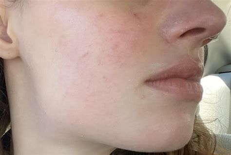 Type 2 Rosacea Going To New Dermatologist Next Week Rrosacea