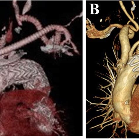 Representative Image Of 3 D Computed Tomography After Debranching