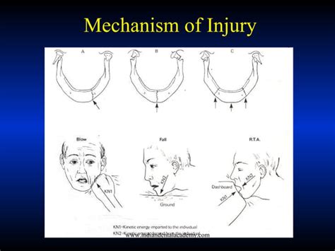 Condylar Fractures Certified Fixed Orthodontic Courses By Indian