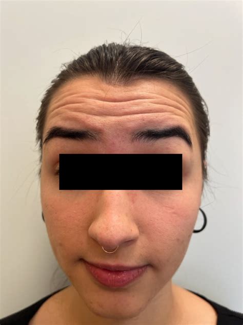 Botox Before And After Dedham Medical Aesthetics