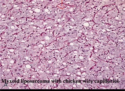 Soft Tissue Tumors Flashcards Quizlet