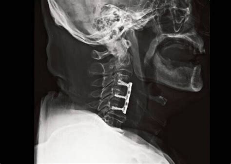 Cervical Spine Surgery