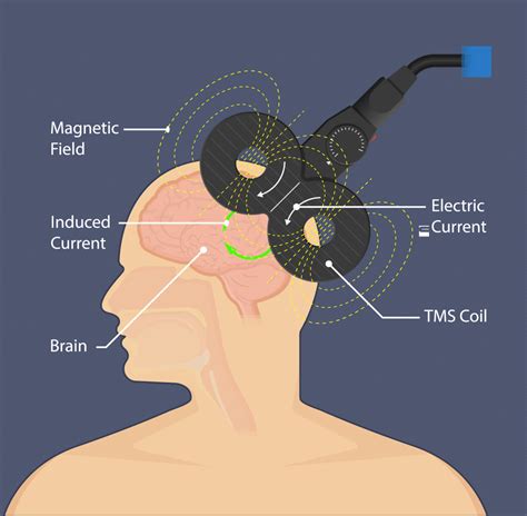 The Science Behind Tms Brain Mapping Gemini Tms Daytona Fl