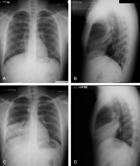 Silhouette Sign Right Middle Lobe Pneumonia Initial Frontal A And