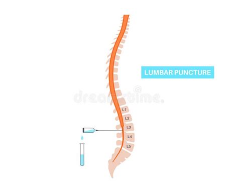 Lumbar Puncture Spinal Tap Stock Vector Illustration Of Inject 366641318