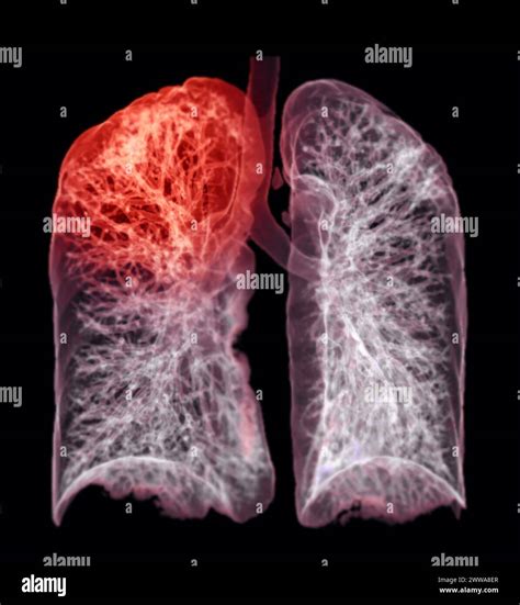 A Ct Chest 3d Scan Displaying A Lesion At The Right Upper Lobe Offers A
