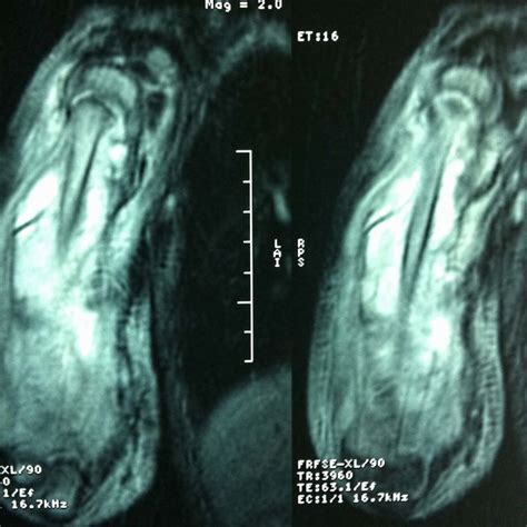 The Sagittal Ultrasound Image Shows Heterogeneous Hypoechoic Lesions