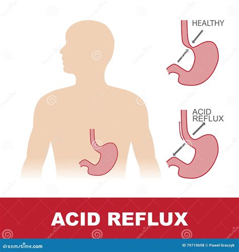 Acid Reflux Stomach Disease Stock Vector Illustration Of Surgery