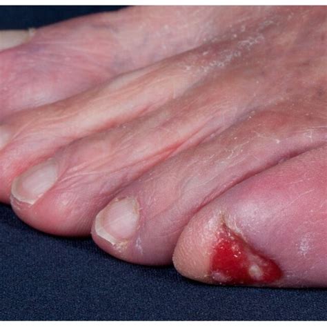 Example Of An Scc On The Toe Presenting As A Chronic Ulcer Of An
