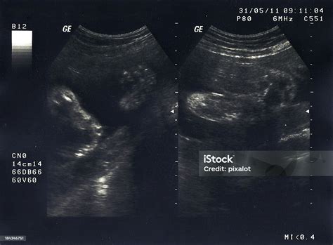 Foto de Ultrassom De Um Feto De 24 Semanas e mais fotos de stock de ...