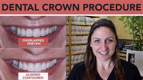 Anterior Crown Fracture