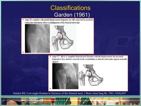 Femoral Neck Fractures Pptx