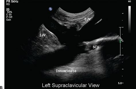 Upper Extremity Venous Thrombosis Thoracic Key