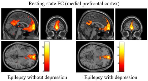 The Impact Of Resting State Functional Connectivity Alterations Due To Comorbid Depressive