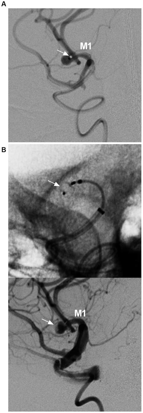 Frontiers Endovascular Treatment Of Middle Cerebral Artery Aneurysms