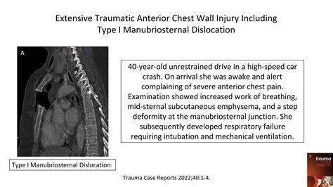 Sternal Fractures And Dislocations Emguidewire Radiology Reading Room Pptx