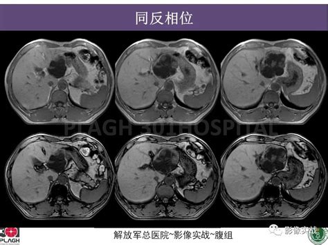 病例肝内胆管囊腺癌1例MR 影像PPT