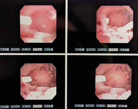 Embedded Iud Rcopperiud