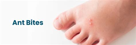 Impact Of Ant Bites Remedies And Relief Strategies