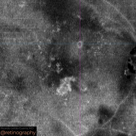 Dme Telangiectatic Capillaries Retinography