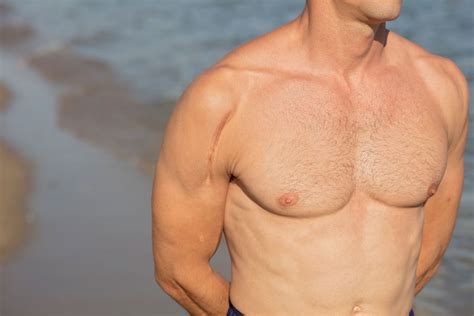 How To Get Rid Of Stretch Marks Men