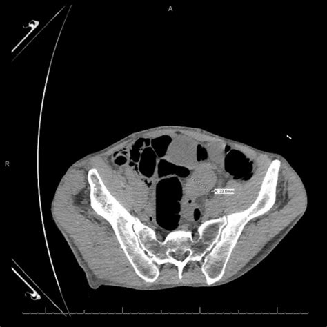 Giant Inflammatory Polyps In Diverticular Disease Mimicking A Colonic