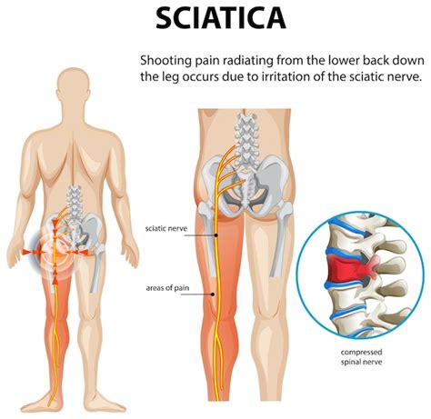 Understanding Sciatica And Nerve Pain เวกเตอร์พรีเมียม