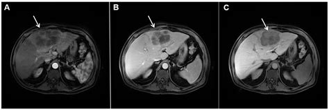 Cholangiocarcinoma Radiology