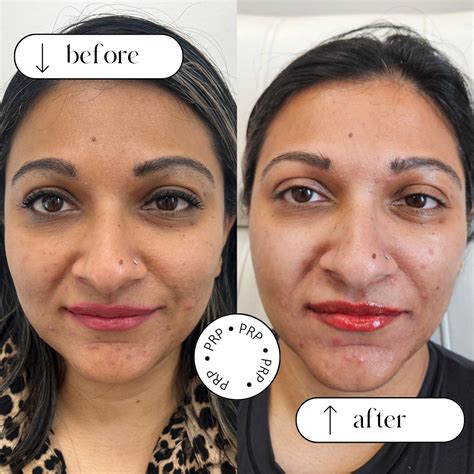 Prp Under Eye Treatment In Niagara Reduce Dark Circles And Puffiness — Np Medical Niagara