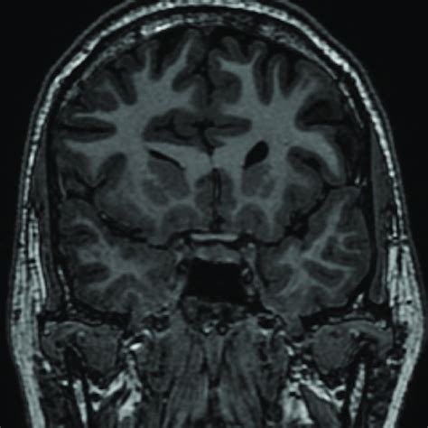 Right Medial Frontal Polymicrogyria Download Scientific Diagram