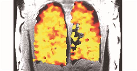 New Scan Method Unveils Lung Function Secrets Press Office